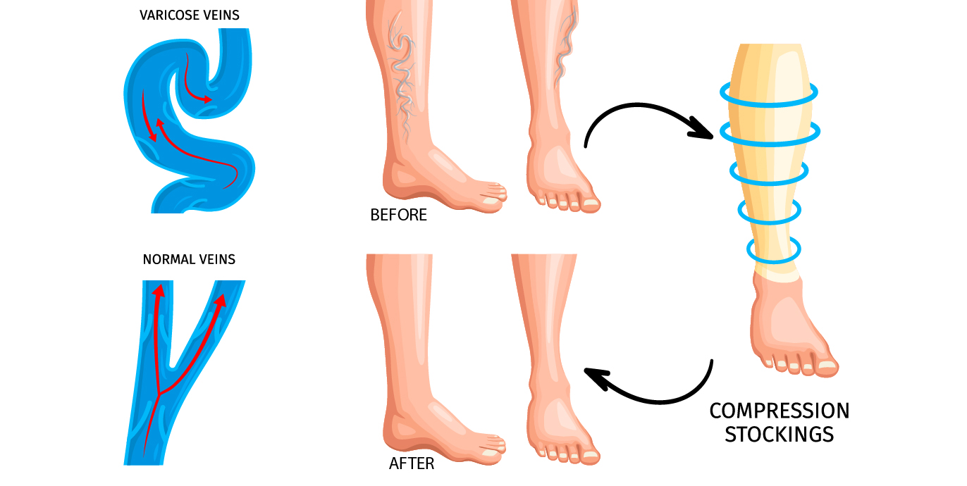 Managing Varicose Veins with Compression Stockings | Ship Hospital